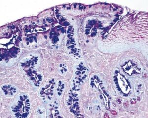 Barrett’s Esophagus - The Operative Review Of Surgery