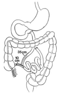 Bariatric Surgery - The Operative Review Of Surgery