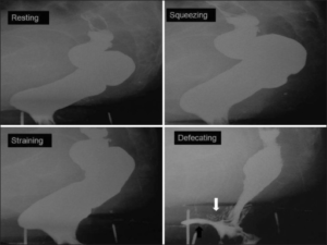Rectocele - The Operative Review Of Surgery
