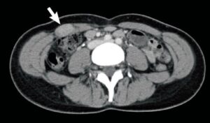Desmoid Tumor - The Operative Review Of Surgery