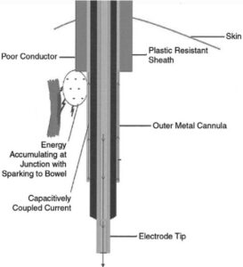 Surgical Energy - The Operative Review Of Surgery