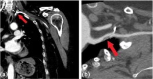 Arterial Thoracic Outlet Syndrome - The Operative Review Of Surgery