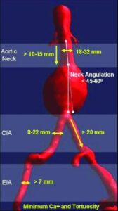 AAA Repair - The Operative Review Of Surgery