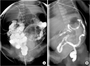 Meconium Ileus - The Operative Review Of Surgery