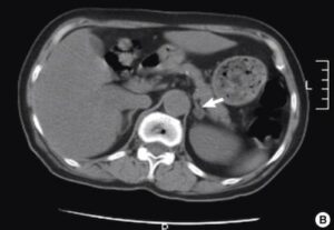 Adrenal Incidentaloma – The Operative Review Of Surgery