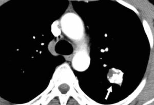 Other Lung Tumors - The Operative Review Of Surgery