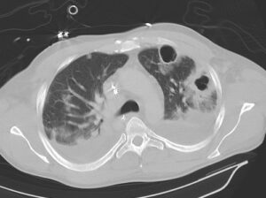 Lung Abscess - The Operative Review Of Surgery