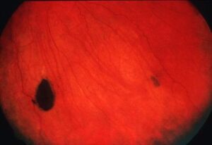 Familial Adenomatous Polyposis - The Operative Review Of Surgery