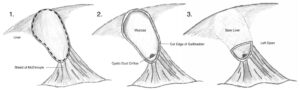 Subtotal Cholecystectomy - The Operative Review Of Surgery